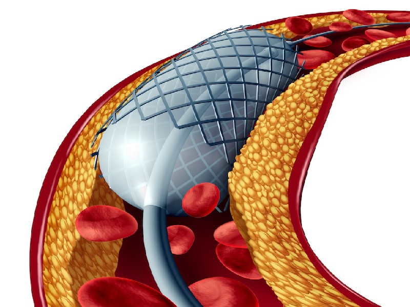 Coronary Angioplasty Turkey& Istanbul, compare best clinic prices