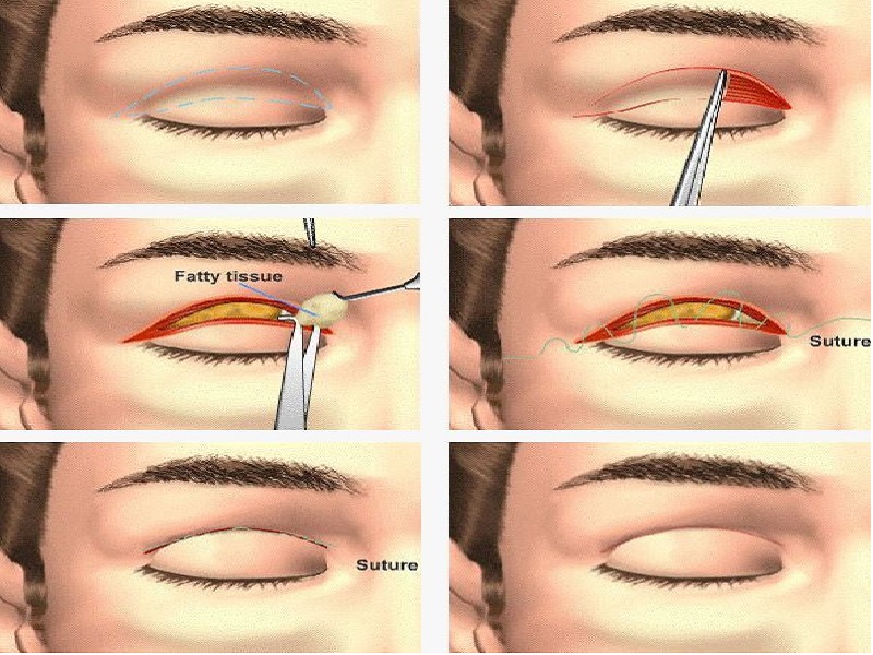 Blépharoplastie unilatérale en Turquie Avis, Prix à partir de 1100
