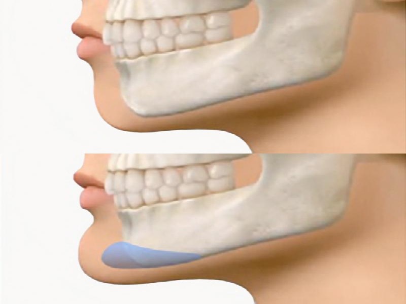 Genioplasty Turkey, best prices