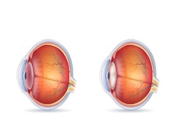 Chirurgie de la Cataracte Turquie à 2500€ | TOP Cliniques