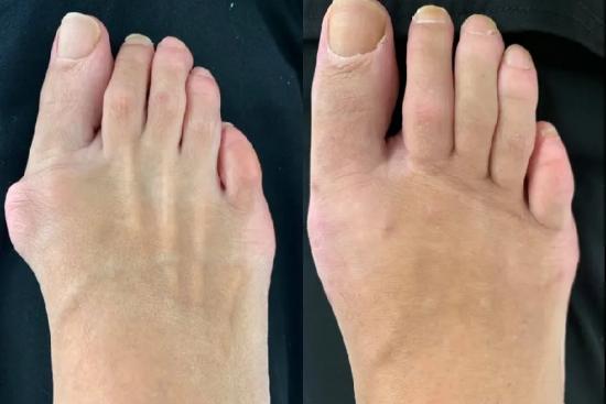 Hallux Valgus Surgery in Turkey: Price and Recovery