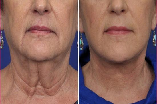 Lifting du cou à Istanbul Turquie | Prix & TOP Cliniques