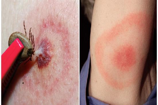 Maladie de Lyme Turquie Istanbul | TOP 3 Cliniques &Prix