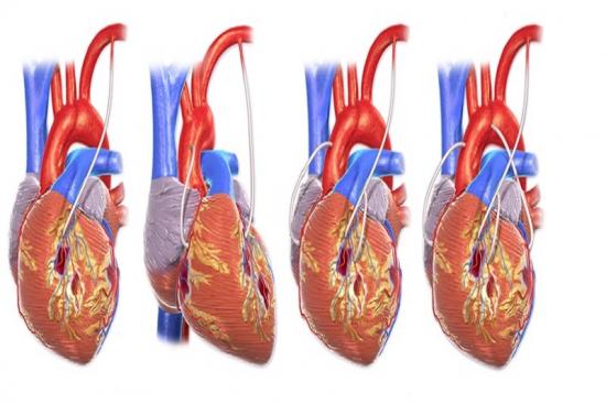 Pontage Aorto-Coronarien (PAC) Turquie | TOP 3 Cliniques