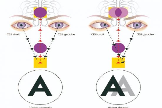 Traitement strabisme Turquie | TOP 3 des Cliniques &Prix
